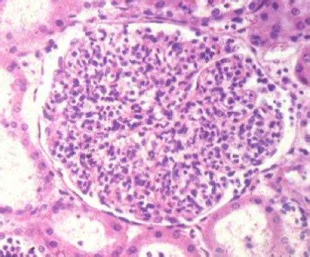 Glomerular Diseases Flashcards Quizlet