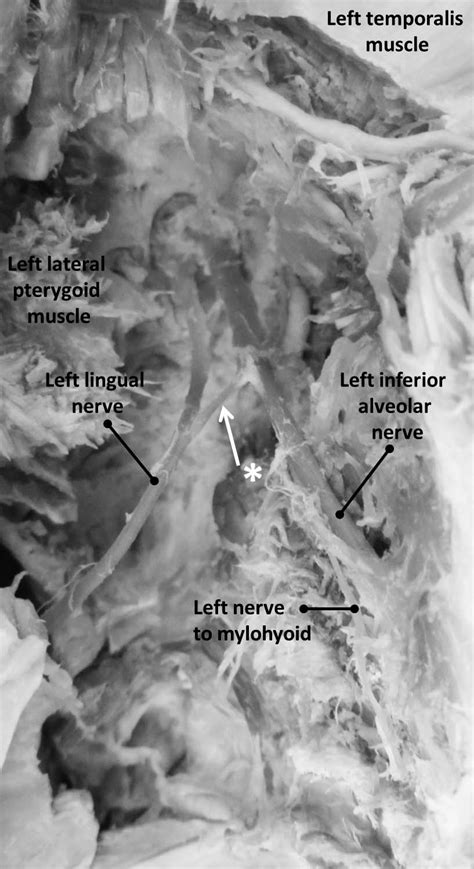 Photograph Of Dissected Left Infratemporal Fossa The Left
