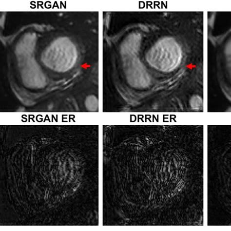 Motion Artifact Reduction On The Acdc Dataset With Representative Six