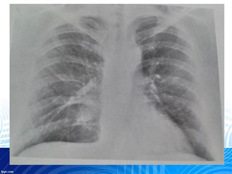 Solitary Pulmonary Nodule Ppt