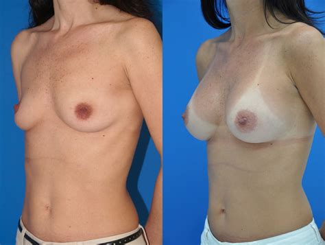 Transaxilary Breast Augmentation Transaxillary Breast Implant Before And After Gallery Shuster