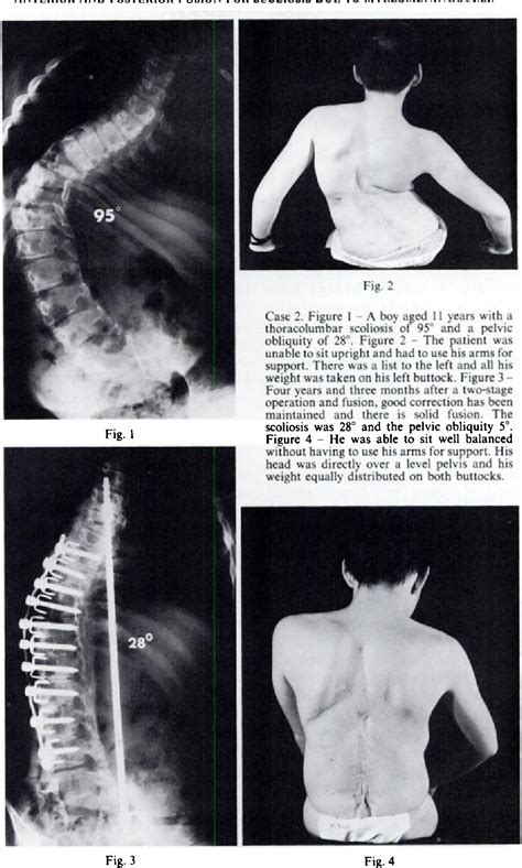 Thoracolumbar Scoliosis Semantic Scholar