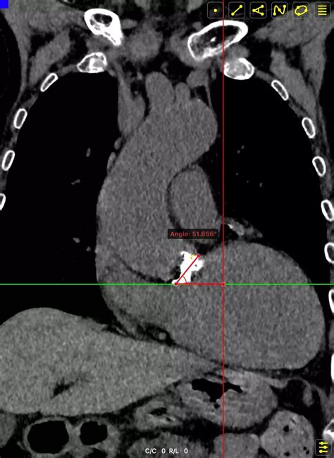 Tavr