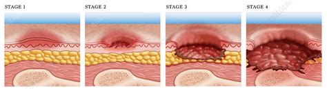 Bed Sores Pictures Stage 1 Stages Of Pressure Sore Evmji