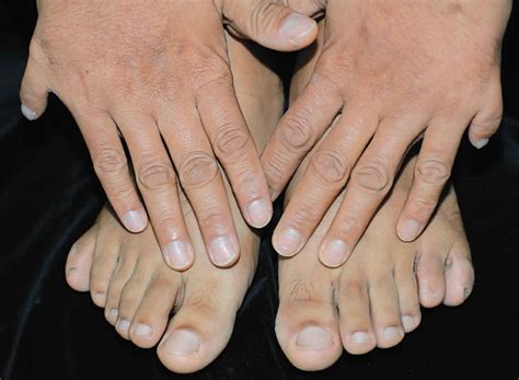 30 Facts About Dandywalker Malformation Postaxial Polydactyly