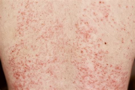 Other Rashes Cathedral Dermatology