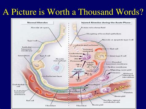 Ppt Ards The Fundamentals Powerpoint Presentation Free Download Id 1569491