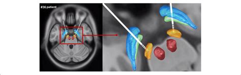 The Reconstruction Image Of 36 Patients Dbs Lead Localization Gpe Download Scientific