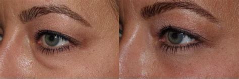 Lower Blepharoplasty Why Fat Preservation Is Essential Dr Guy Massry