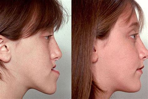 Jaw Problems Treatment Melbourne The Look Orthodontics