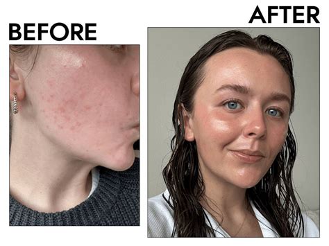 How To Use Tretinoin A Comprehensive Guide