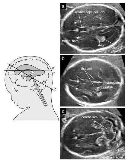 How To Perform An Effective Fetal Brain Ultrasound Dr Syed Yousaf