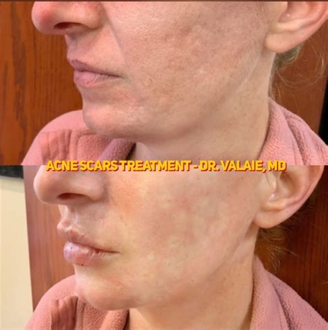 Scars And Acne Scars Injection Orange County Dr Valaie