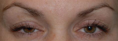 Before And After Ptosis Repair In Atlanta Ga Oculus