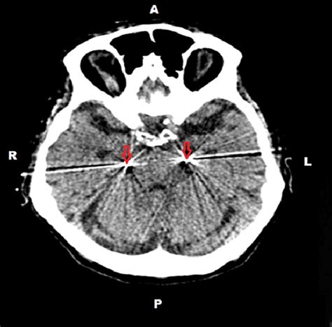 Postoperative Cranial Ct Of The Patient The Postoperative Ct Download Scientific Diagram