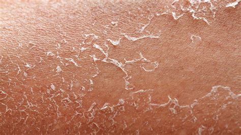 Understanding Different Types Of Skin Peels Seacra Skincare