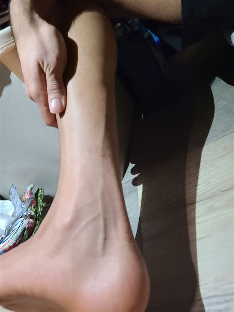 Bulging Veins Reactions Rdysautonomia