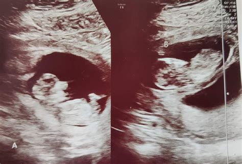 Just Had The 2nd Ultrasound Currently At 15 Weeks And Waiting To Hear