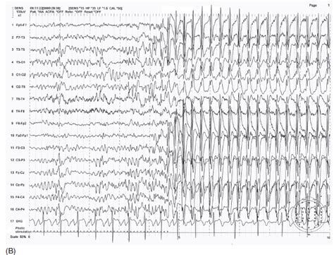 Eeg Spikes