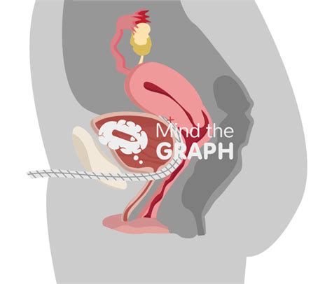 Cystocele Correction Lateral Cut