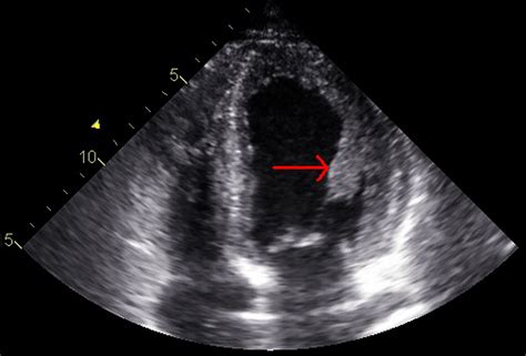 Prominent Papillary Muscles In Fabry Disease A Diagnostic Marker