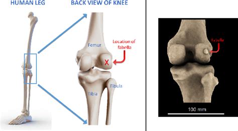 figure 1 from detecting and characterizing the fabella with high frame