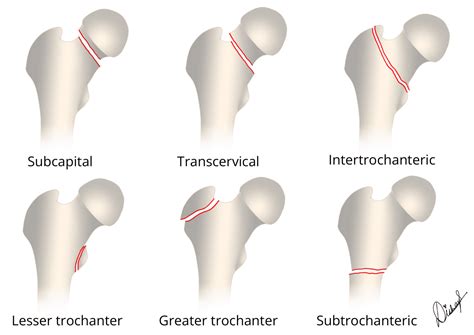 Proximal Femoral Fractures Radiology Case