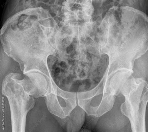 Poster X Ray Of A Femoral Neck Fracture Wall Art Ukposters