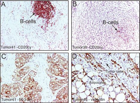 Ihc Of Tumors Reacted With Various Antibodies A Tumor 41 Reacted With