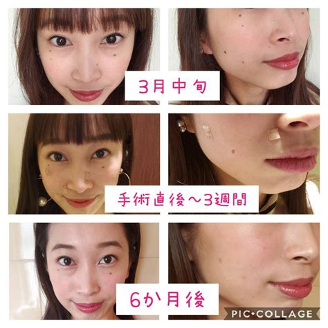 【ホクロ除去体験】with Girlsの術後から6ヵ月の変化を大公開！【with Girlsブログピック】 With Online