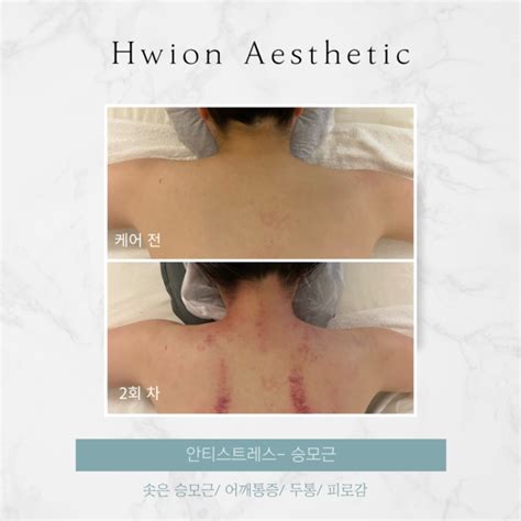 Anti 스트레스 솟은 승모근 어깨 통증 두통 피로감 Hwion