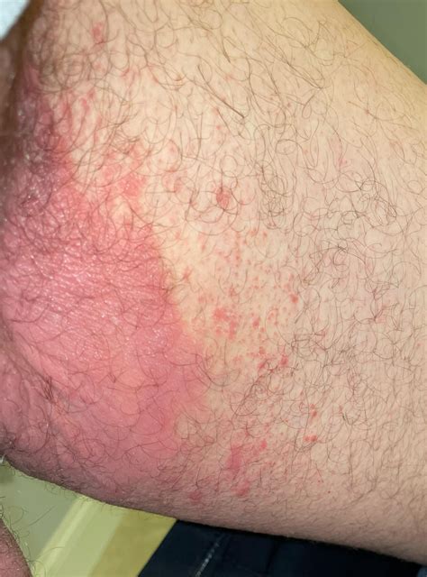 Persistent Red Rash On Upper Thigh Getting Worse Thought It Was Eczema