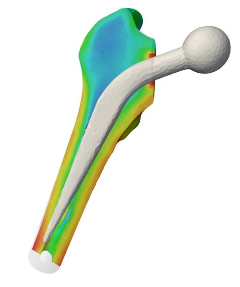 Bone Remodeling And Fracture Mesh Oriented Solutions
