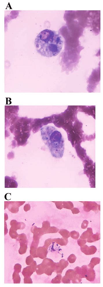 A And B Bone Marrow Aspirate Smear And C Peripheral Blood Smear