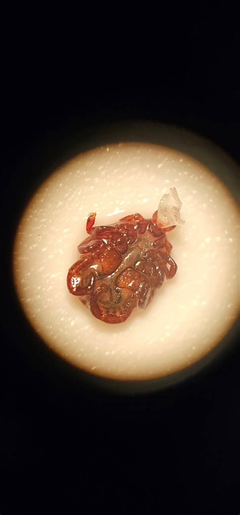 Guy Pulls A Tick Off Himself And Throws It Under A Dissecting