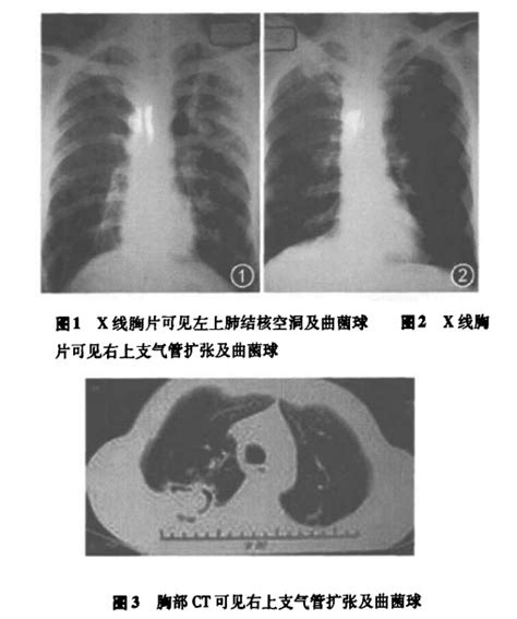 肺曲菌球 A 医学百科