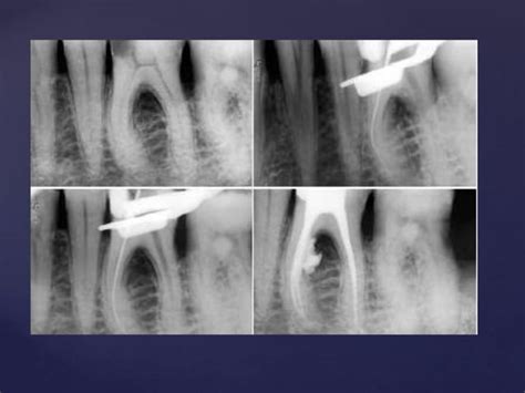 Curved And Dilacerated Canals Pptx Dental Health Diseases And