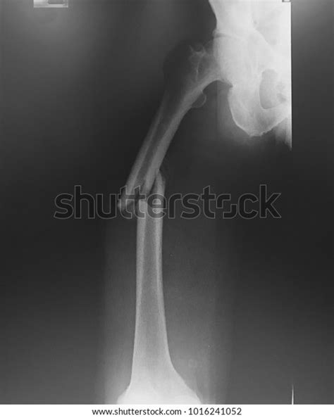 X Ray Femur Ap Lat