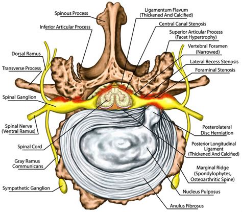 Degenerative Disk Disease Causes Symptoms Diagnosis Exercises