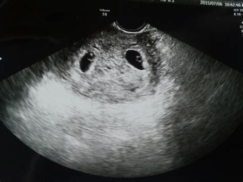 이란성쌍둥이요