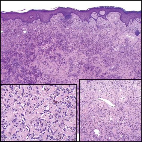Large Hyperpigmented Nodule On The Leg Mdedge