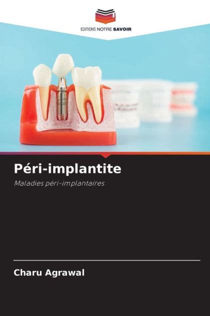 Péri Implantite By Charu Agrawal Paperback Barnes And Noble®