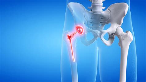 Scientists To Develop The Coatings For Titanium Implants To Fasten