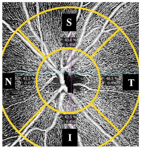 Peripapillary Microvascularization Map Perfusion Density P Is