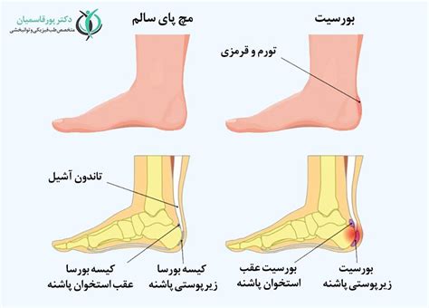 درد پشت پاشنه آشیل پا چه علتی دارد و چگونه درمان می‌شود؟ کلینیک درد