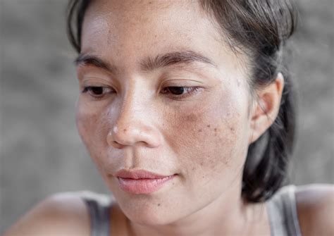Melasma And Pigmentation Solutions Da Vinci Clinic Da Vinci Clinic