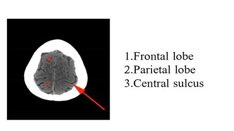 Ct Scan Of Brain Ct Scan And Mri