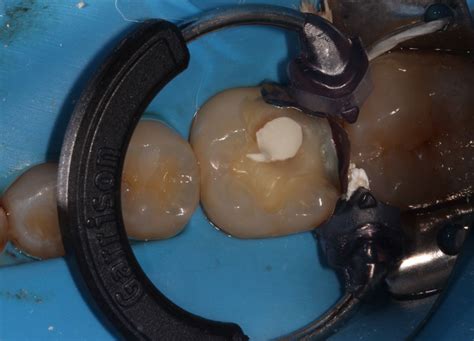 Pulp Capping Can We And Should We Spear Education