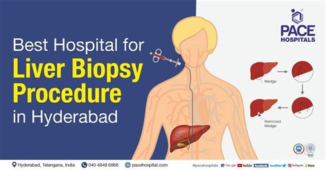 Liver Biopsy Procedure In Hyderabad Types Indications And Cost