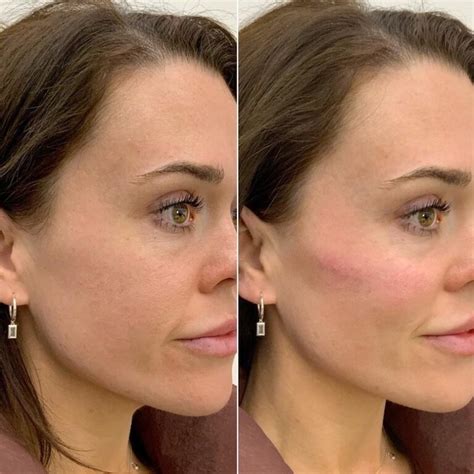 Cheek Filler Before And After Transforming Your Appearance With Subtle Enhancements Must Read